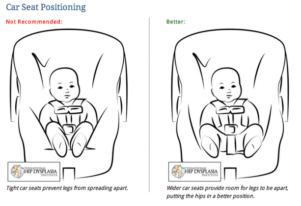 Hip Dysplasia in Babies - Lopinion - GLBrain.com